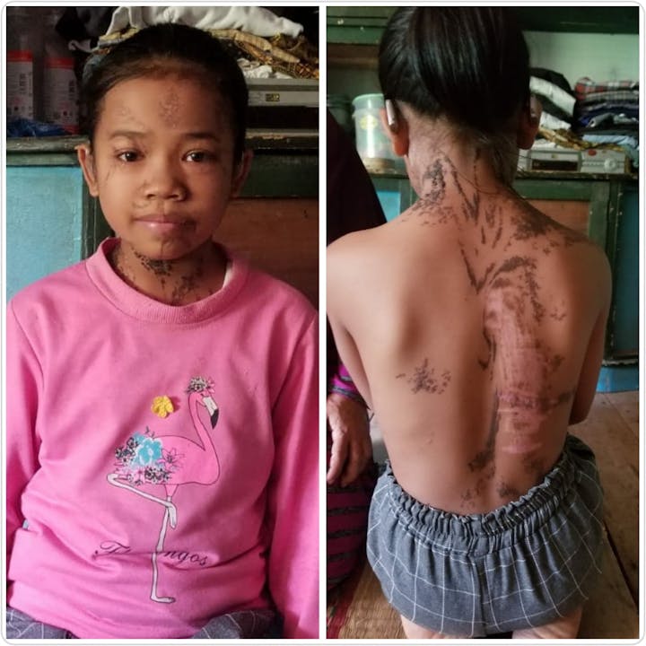 Bantu Eka Sembuh Dari Penyakit Kulit Langka Bantu Eka Sembuh Dari Penyakit Kulit Langka