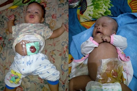 Bayi Alira Mengalami Infeksi Pada Stoma Karena Tidak Memiliki Anus